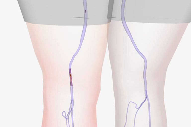 Deep Vein Thrombosis - VEC Specialists Group
